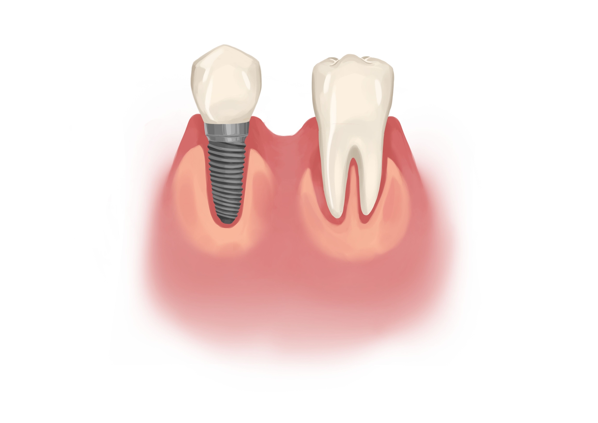 What are the signs of dental implants failure? | Authority Dental
