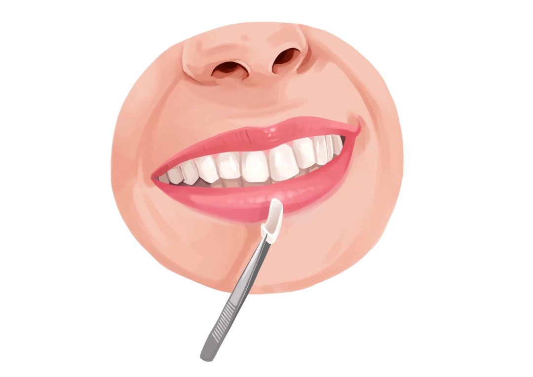 What are receding gums? | Authority Dental