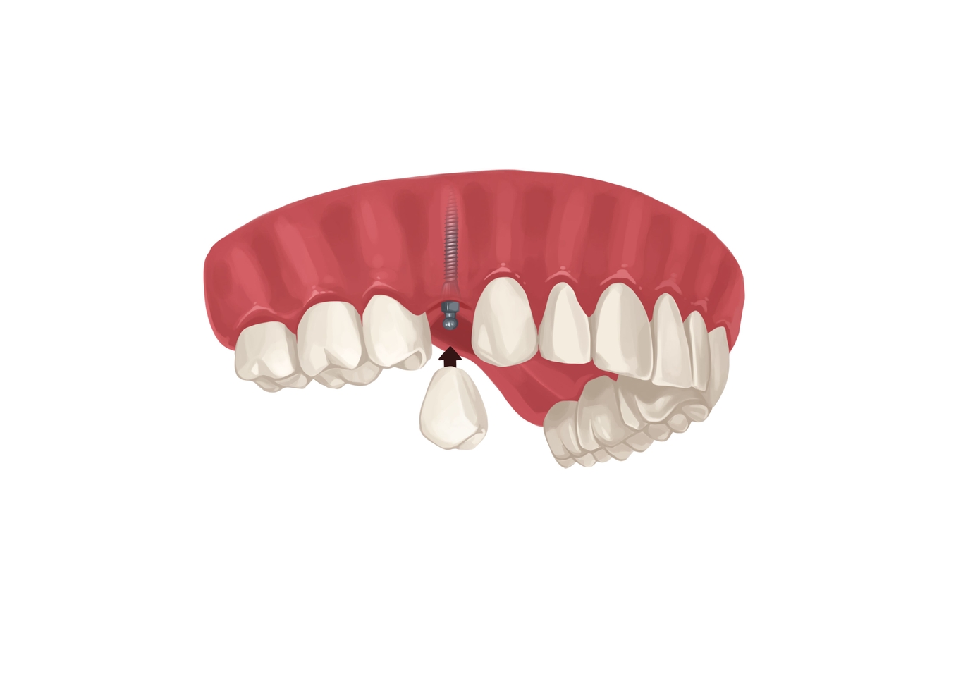 What are mini dental implants? | Authority Dental