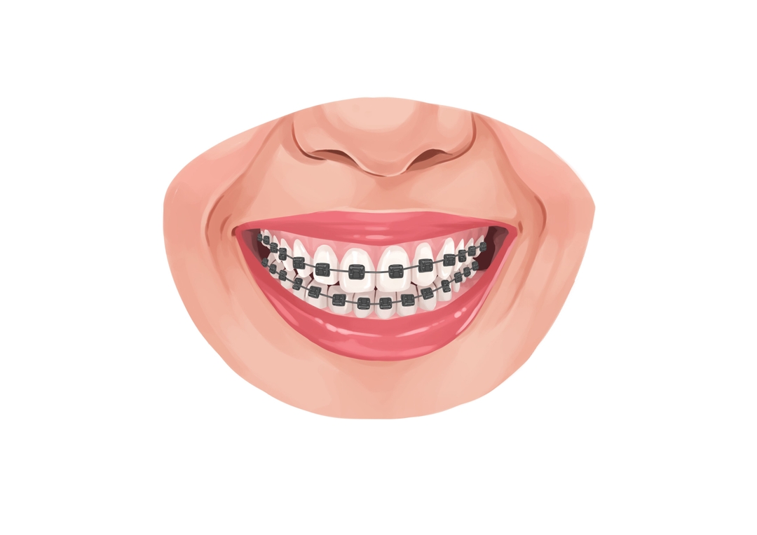 What are the different types of braces? | Authority Dental