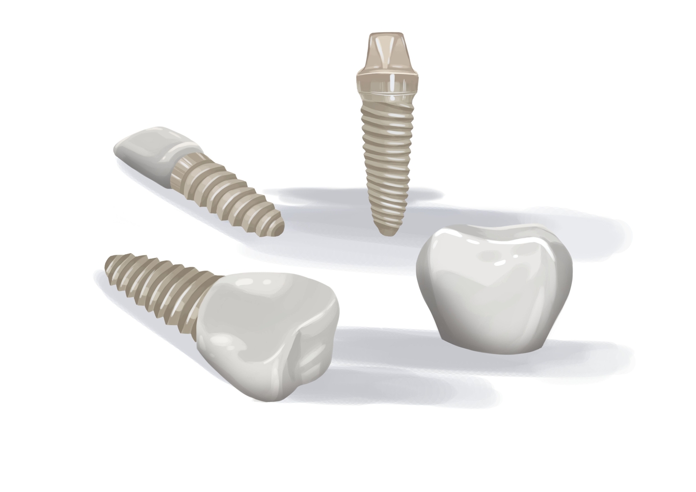 What are the best dental implants brands? | Authority Dental