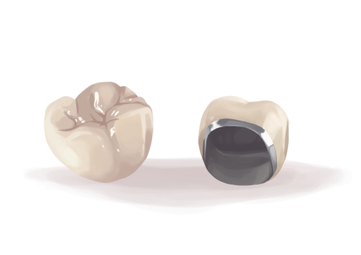 What is a dental crown made of? | Authority Dental