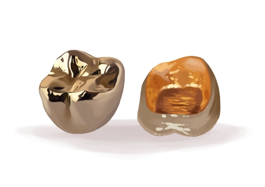 What is a dental crown made of? | Authority Dental