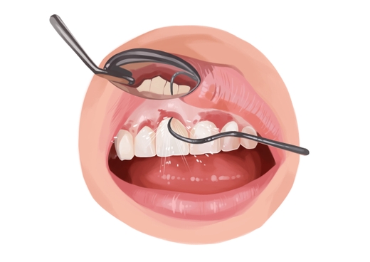 What are receding gums? | Authority Dental